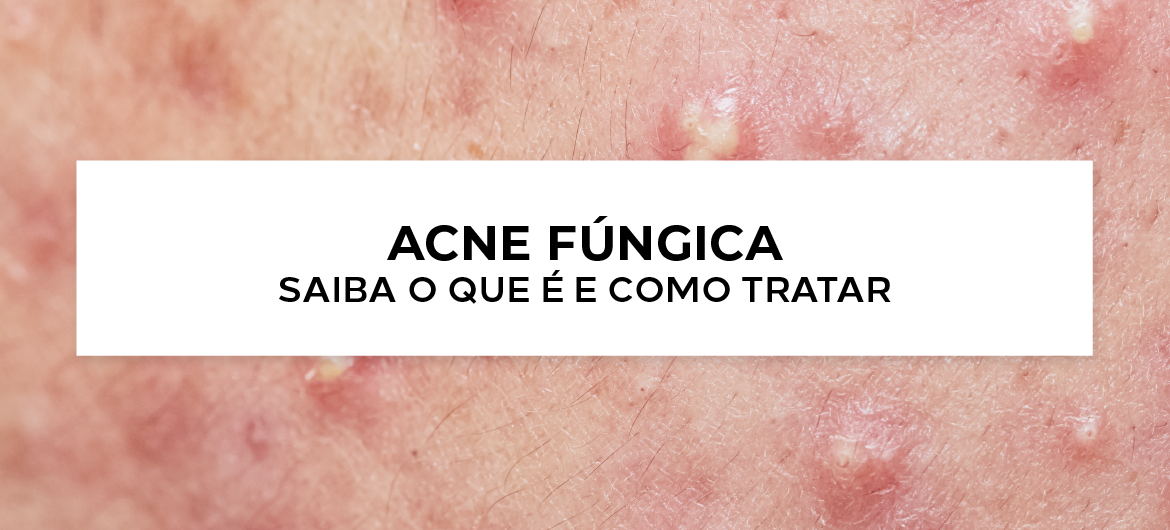 Acne fúngica: Saiba o que é e como tratar – ADA TINA